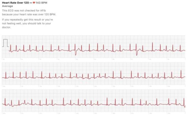 My Apple Watch Detected AFib - Dr. John Day, Cardiologist