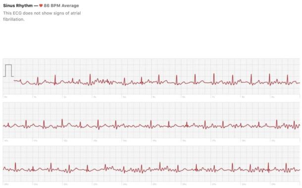 My Apple Watch Detected AFib - Dr. John Day, Cardiologist