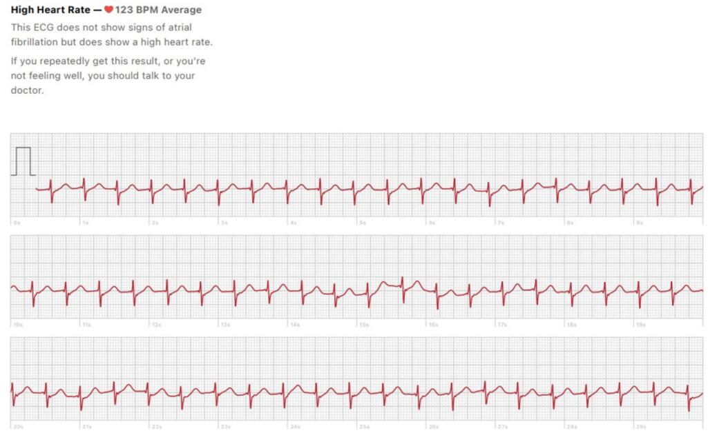 My Apple Watch Detected AFib - Dr. John Day, Cardiologist